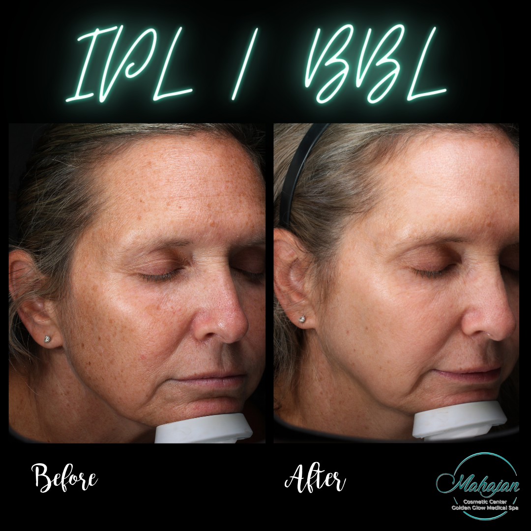 BBL/IPL — Golden Glow Medical Spa