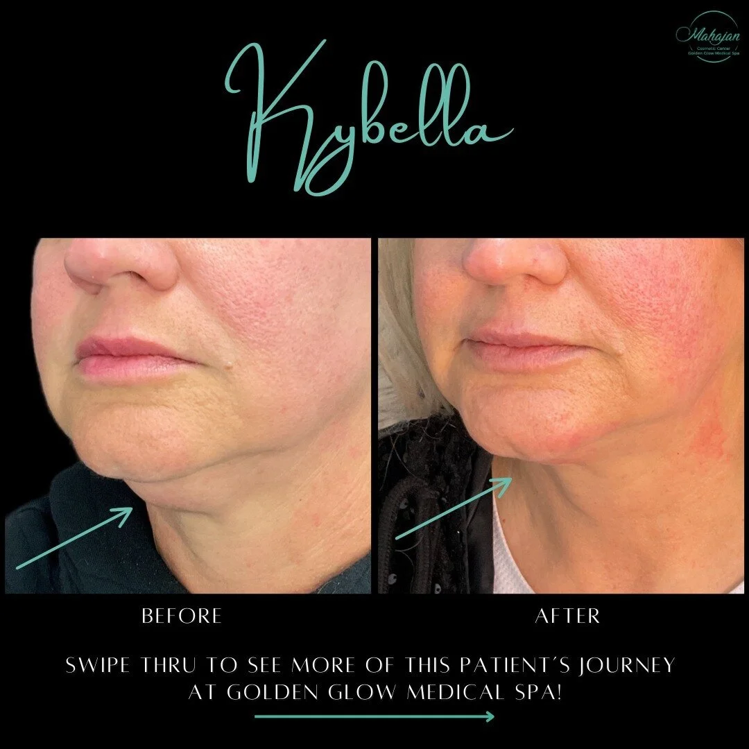 PDO Threads | Belleair Fl | Mahajan Cosmetic Center — Golden Glow ...