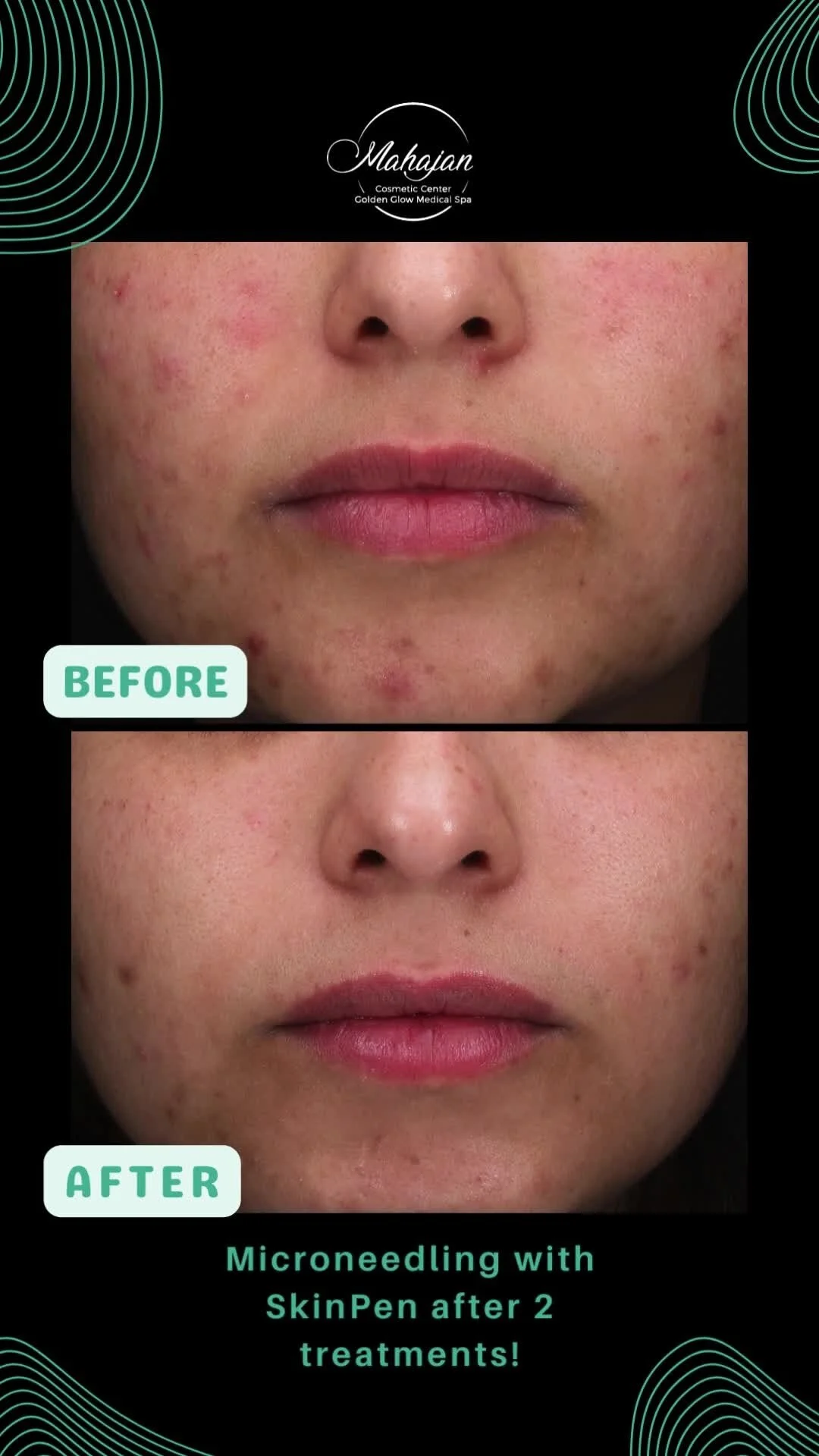 Dermal Fillers — Golden Glow Medical Spa