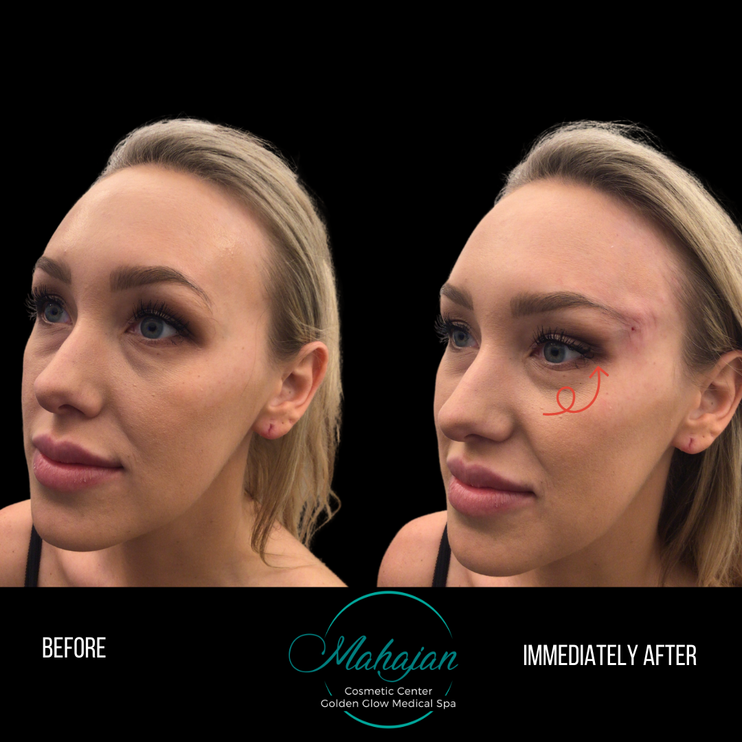 Thread Lift — Golden Glow Medical Spa