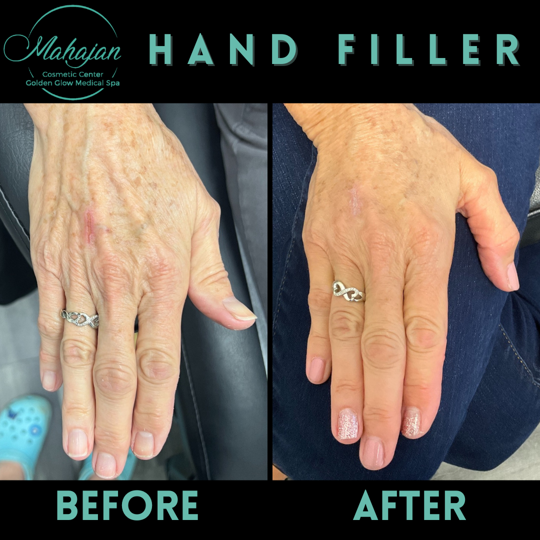 Hand Filler — Golden Glow Medical Spa