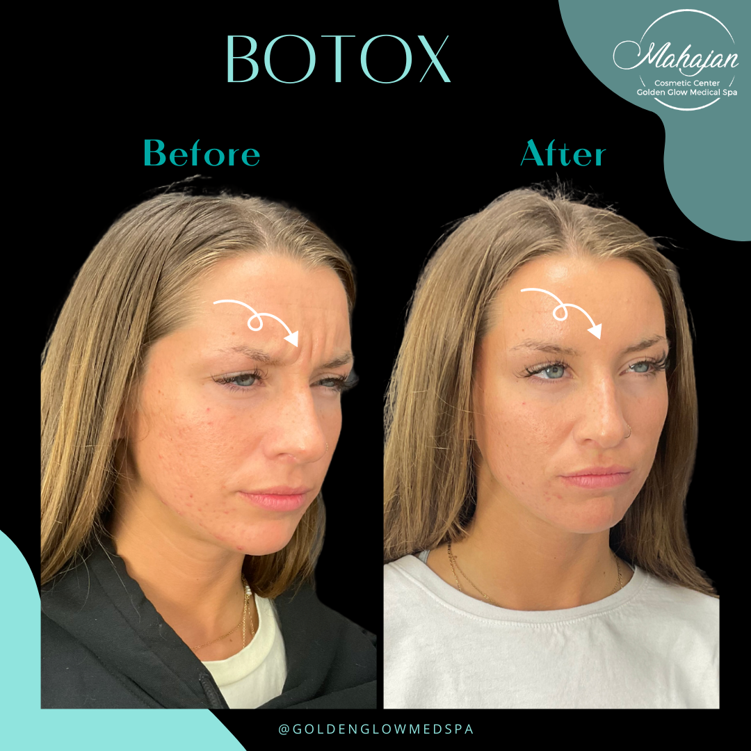 How Much Botox For Glabella: Glabella Botox Injections – CPHBOU