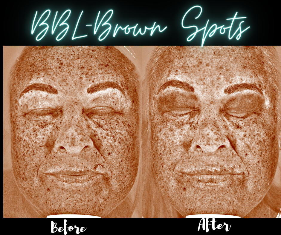 BBL/IPL — Golden Glow Medical Spa