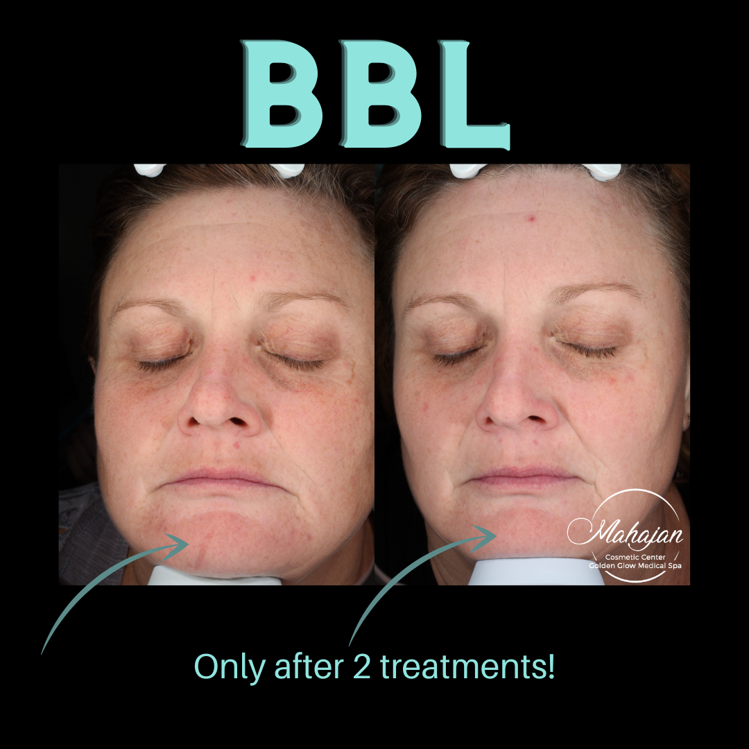 BBL/IPL — Golden Glow Medical Spa