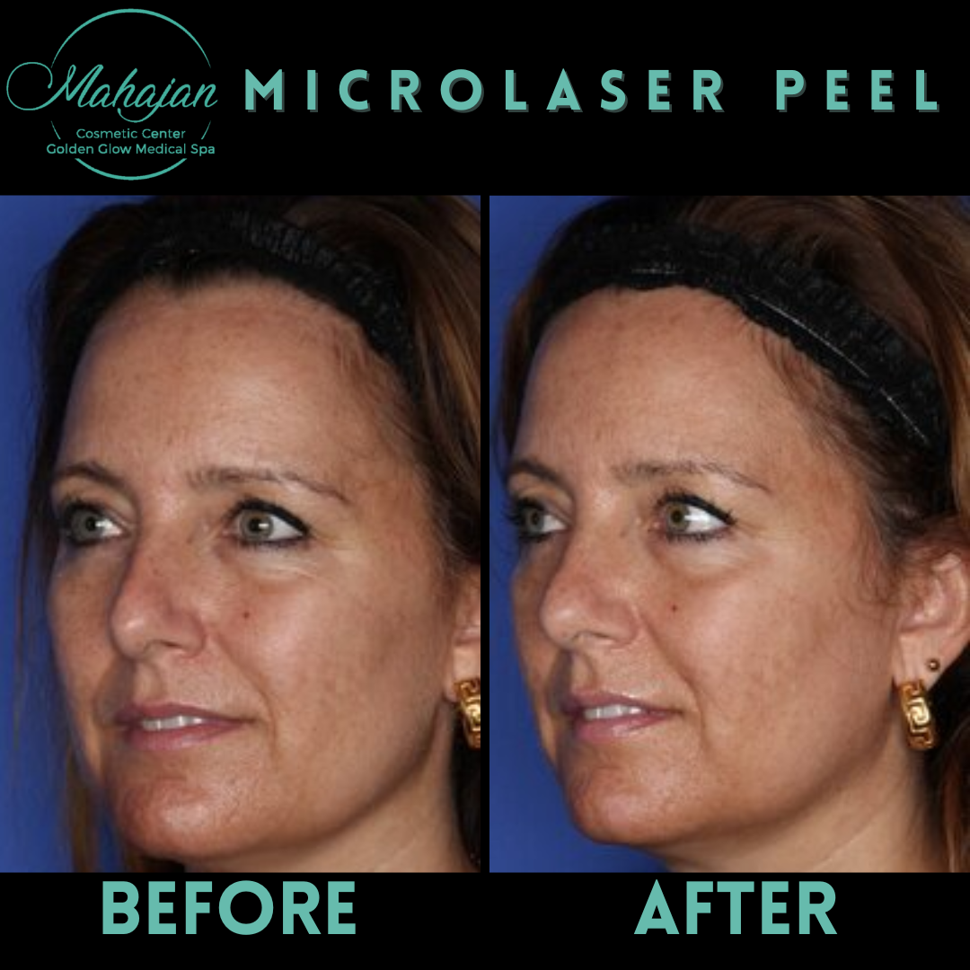 Microlaser Peel — Golden Glow Medical Spa