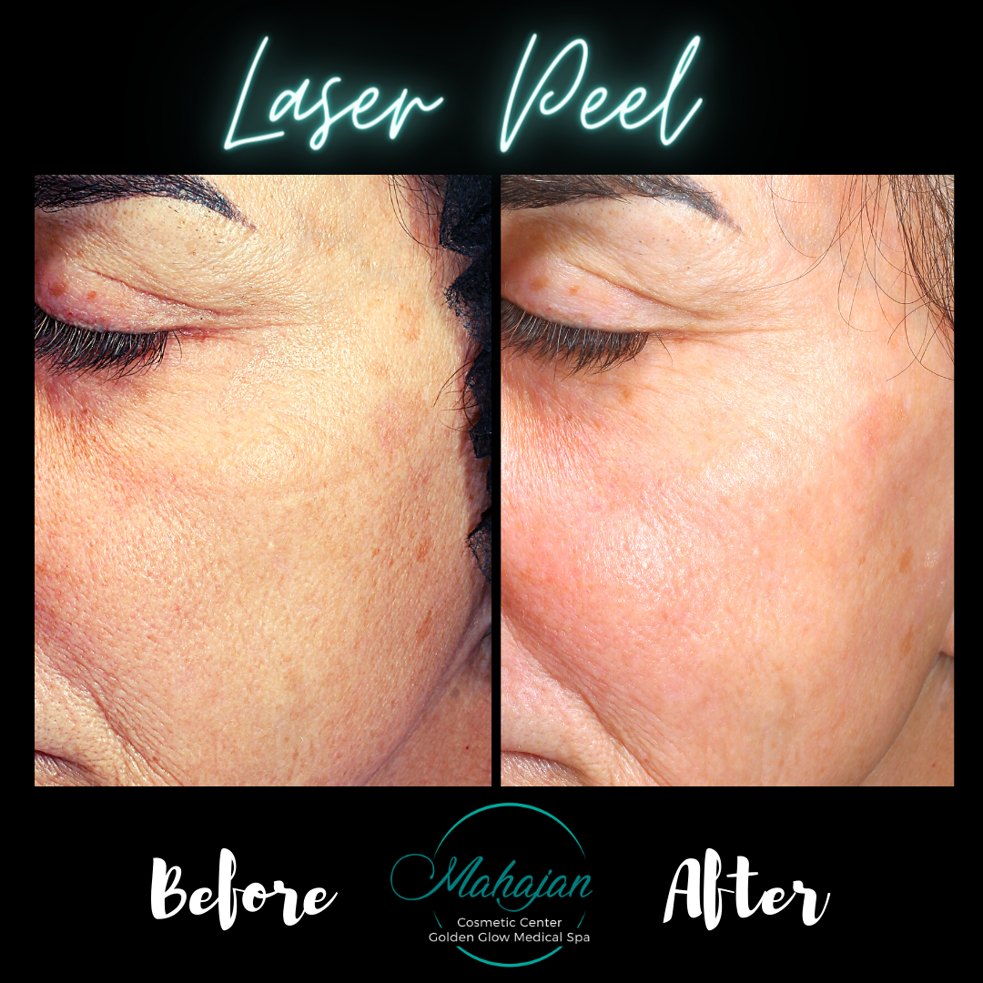 Laser Peel — Golden Glow Medical Spa