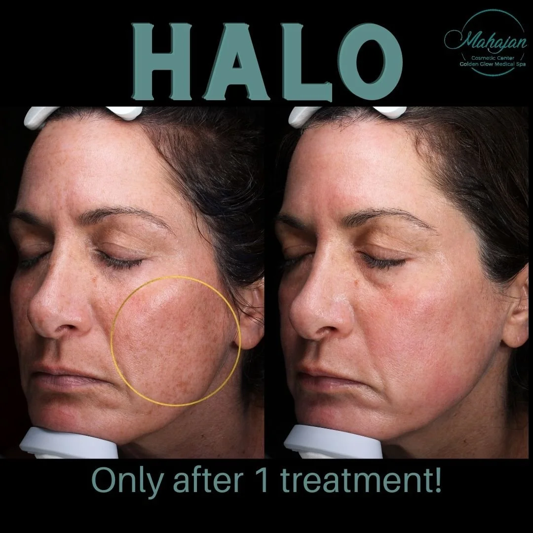 Halo Treatment — Golden Glow Medical Spa