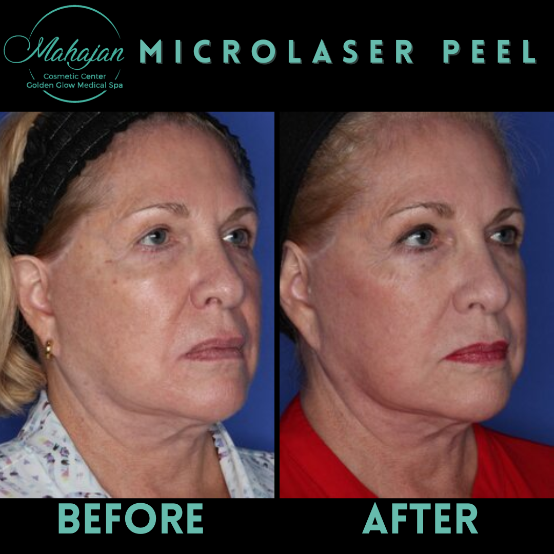 Microlaser Peel — Golden Glow Medical Spa
