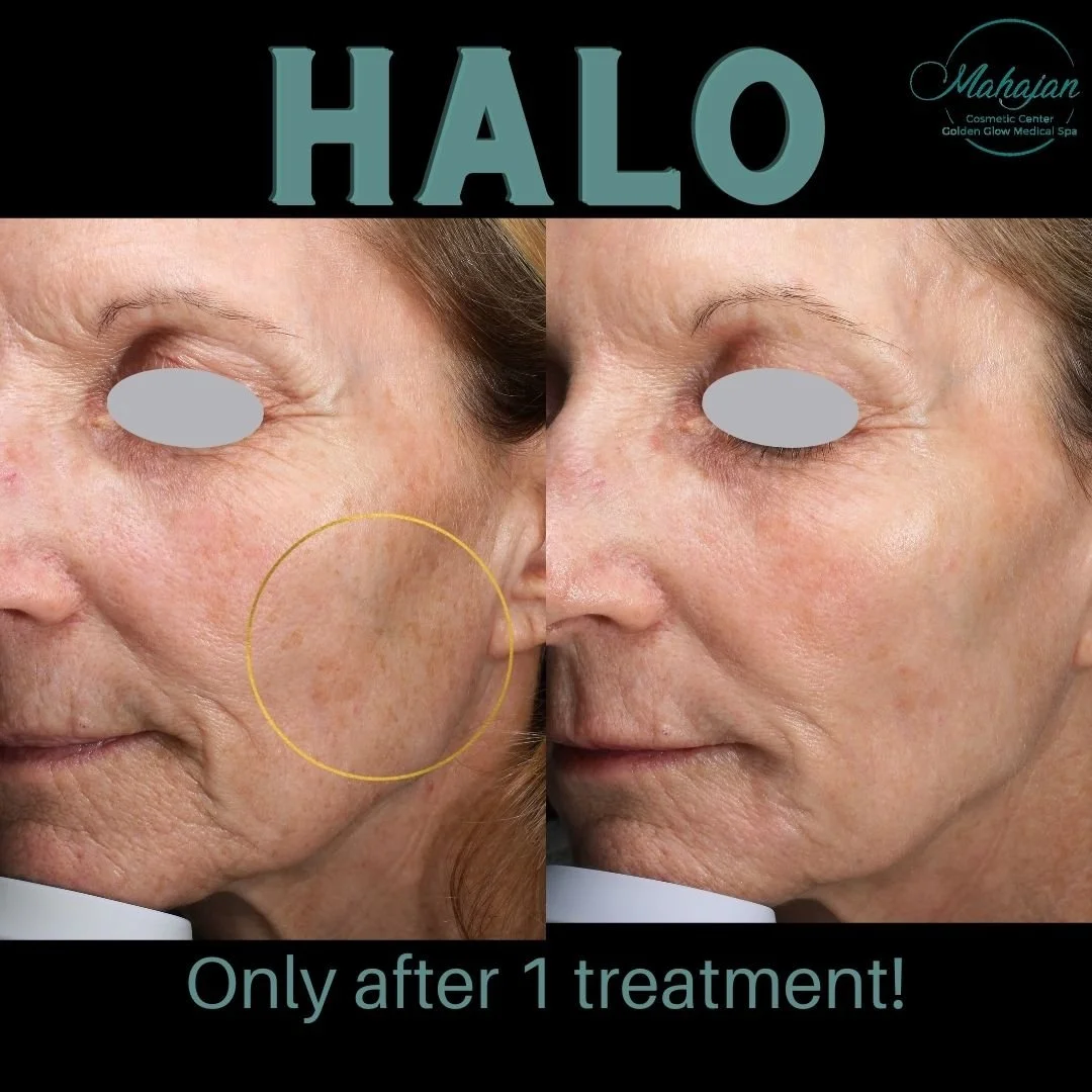 Halo Treatment — Golden Glow Medical Spa