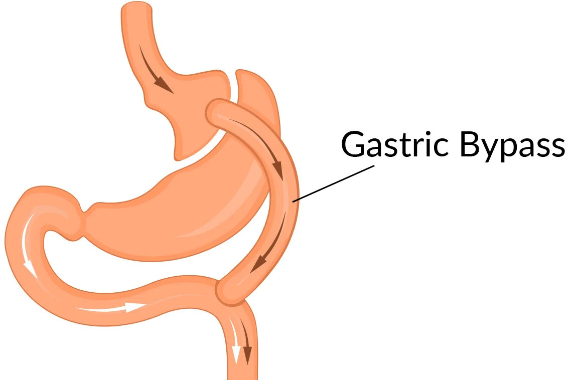 Laparoscopic Roux-en-Y Gastric Bypass (RYGBP) — Dr Marjan (Jane ...