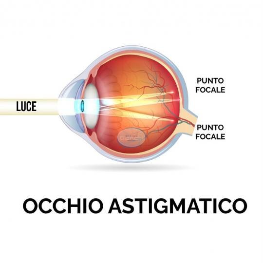 Astigmatismo: Capire e Trattare il Difetto Visivo — Ottica Bianchi La ...