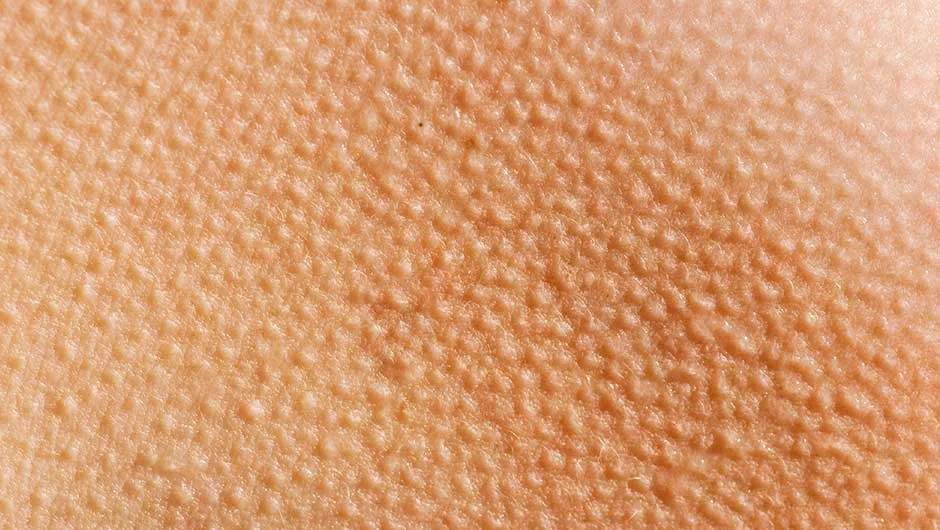 Keratosis Pilaris