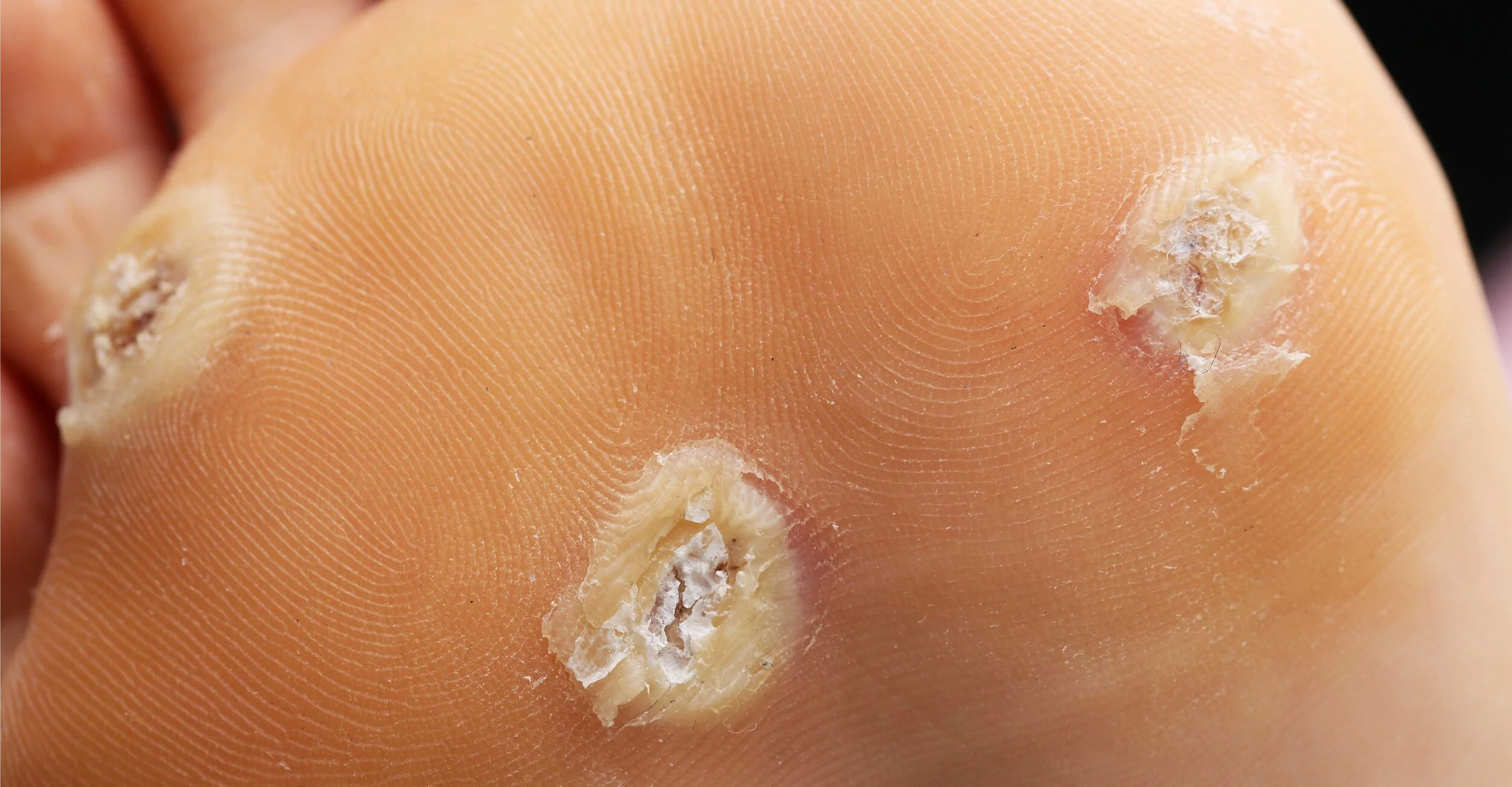 How Do Foot Doctors Remove Plantar Warts At Regena Rudolph Blog How Do Foot Doctors Remove Plantar Warts At Regena Rudolph Blog