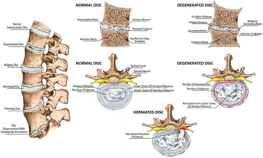 What Are Vertebral Discs? — 919 Spine
