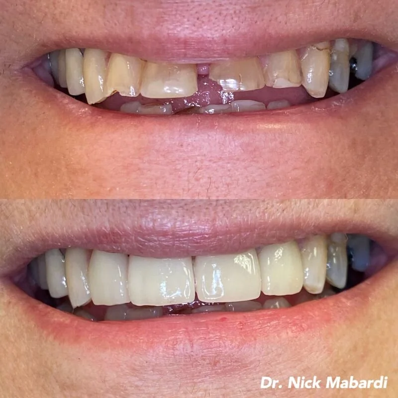 South Miami Smile Gallery | Mabardi Dental Studio