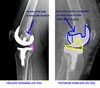 Pros and cons of different types of knee implants - Dr. Kurtz ...