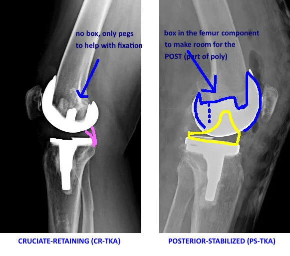Pros and cons of different types of knee implants - Dr. Kurtz ...
