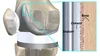 Pros and cons of different types of knee implants - Dr. Kurtz ...
