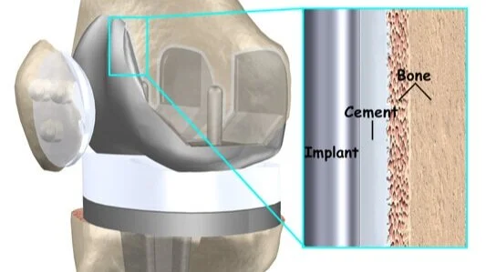Pros and cons of different types of knee implants - Dr. Kurtz ...