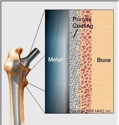 Different types of hip replacements are discussed — Nashville Joint ...