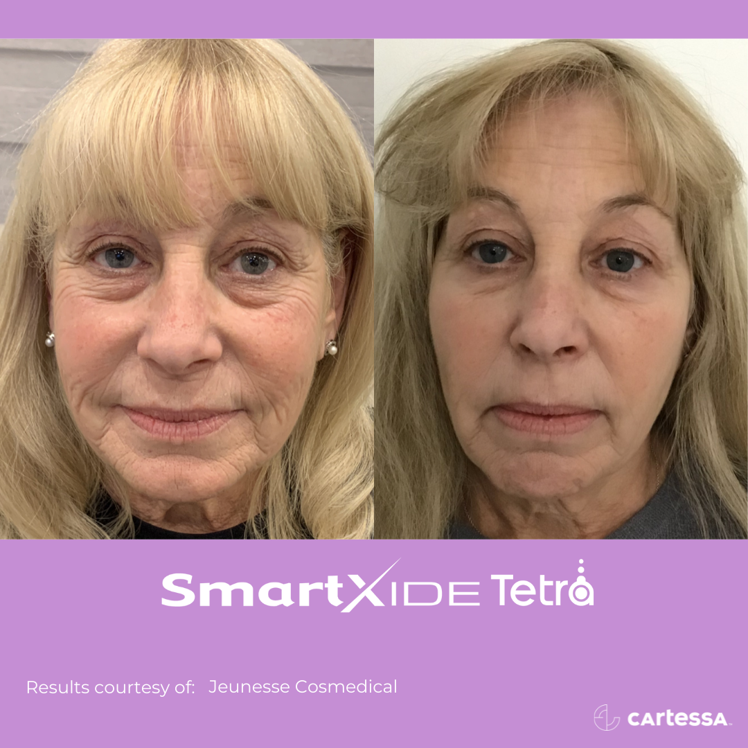 Tetra CO2 Laser Treatment - Cape Coral, FL — The Skin Spot Laser Club ...