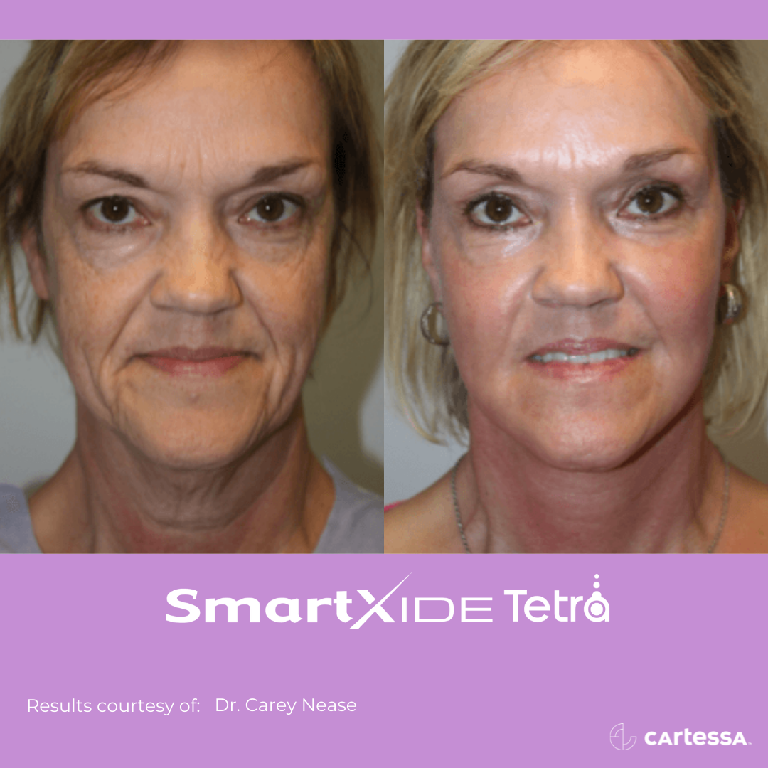 Tetra CO2 Laser Treatment - Cape Coral, FL — The Skin Spot Laser Club ...