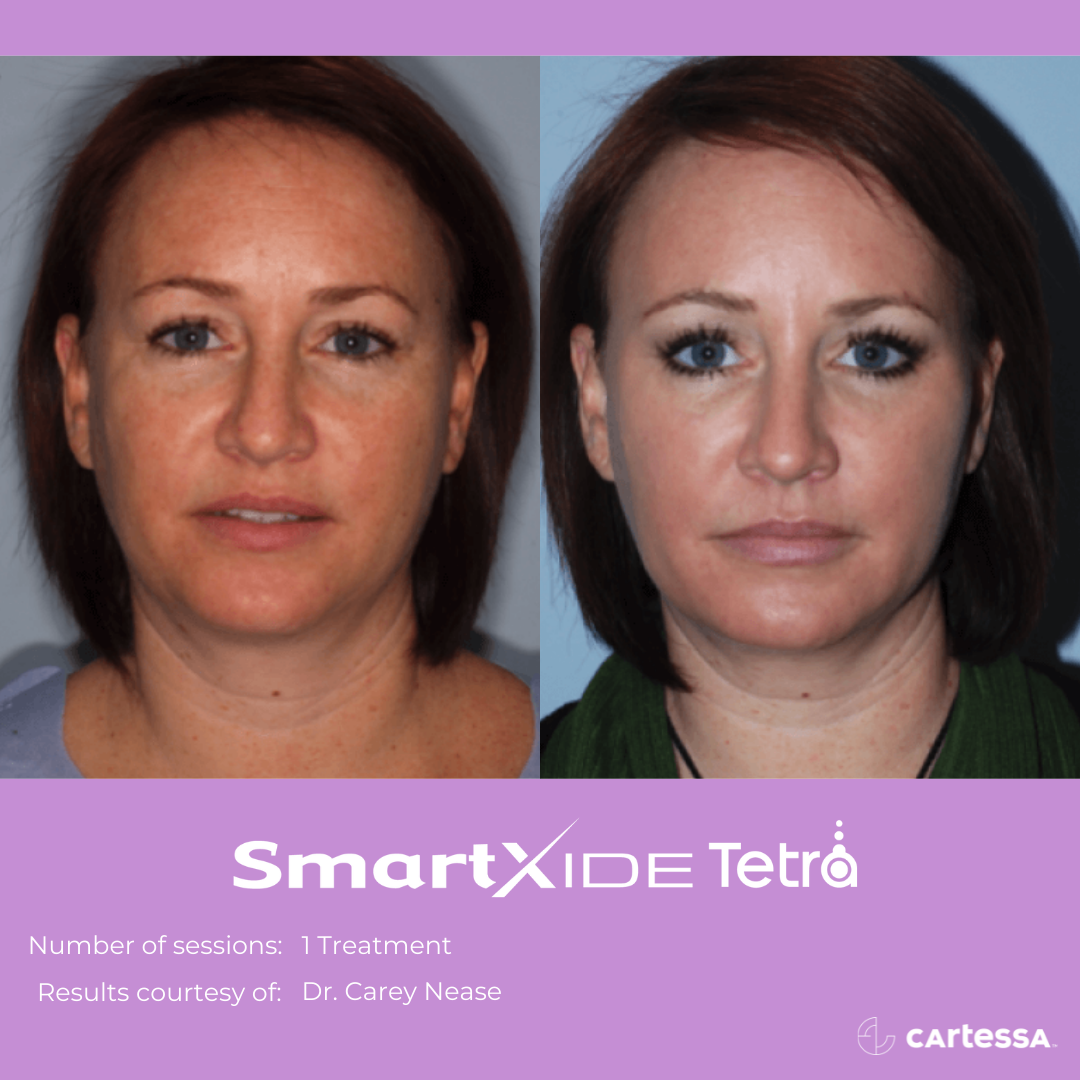 Tetra CO2 Laser Treatment - Cape Coral, FL — The Skin Spot Laser Club ...