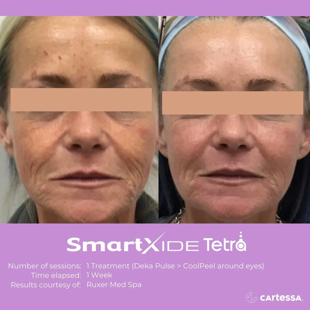 Tetra CO2 Laser Treatment - Cape Coral, FL — The Skin Spot Laser Club ...