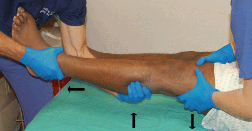 All About Knee Dislocations — USF Emergency Medicine