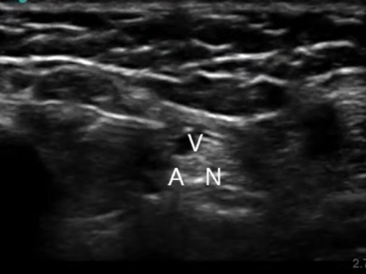 Regional Anesthesia in the Emergency Department — USF Emergency Medicine