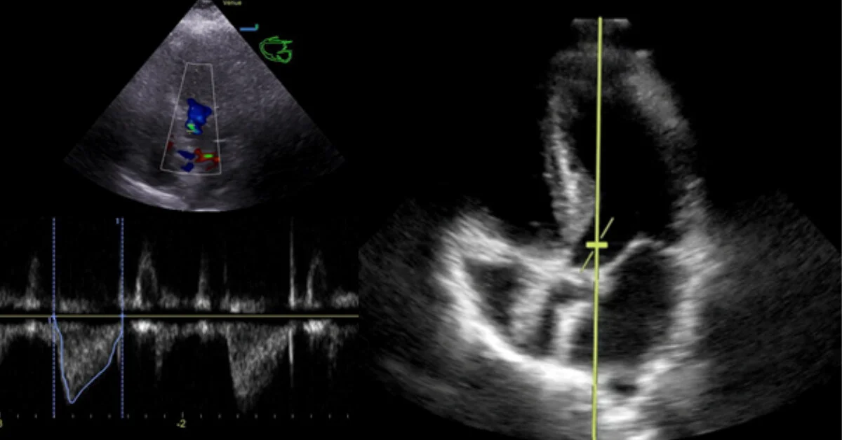 Cardiac VTI - The New IVC for Fluid Responsiveness? — USF Emergency ...