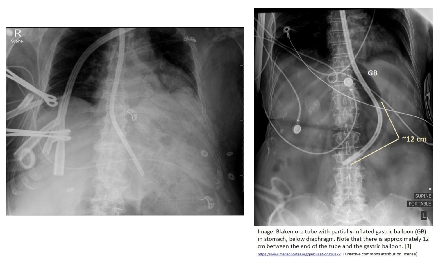 Balloon Tamponade in GI Bleed — USF Emergency Medicine