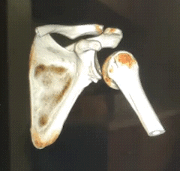 Shoulder Dislocations: Reduction and Stabilization — USF Emergency Medicine