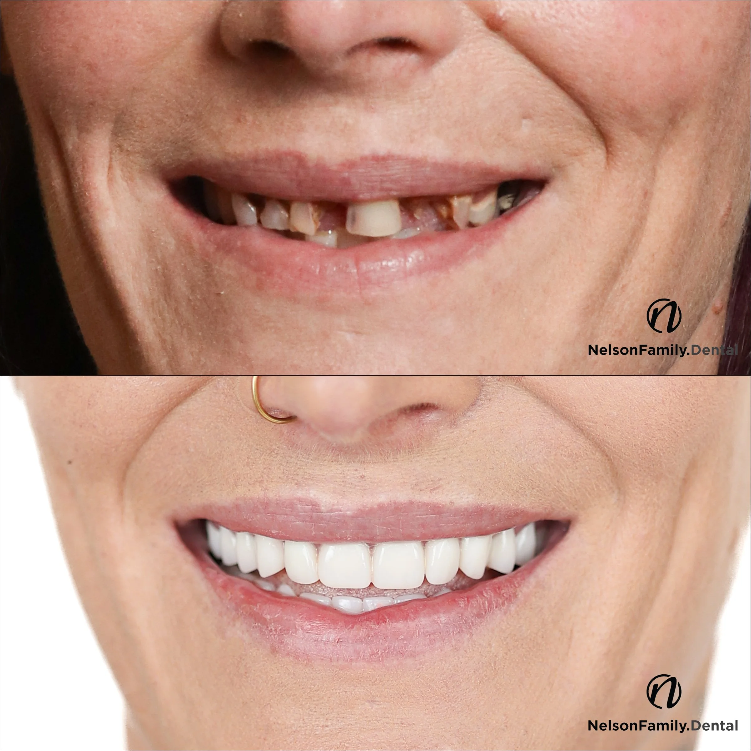 Before and After — Denture.Doctor | Redding, Ca