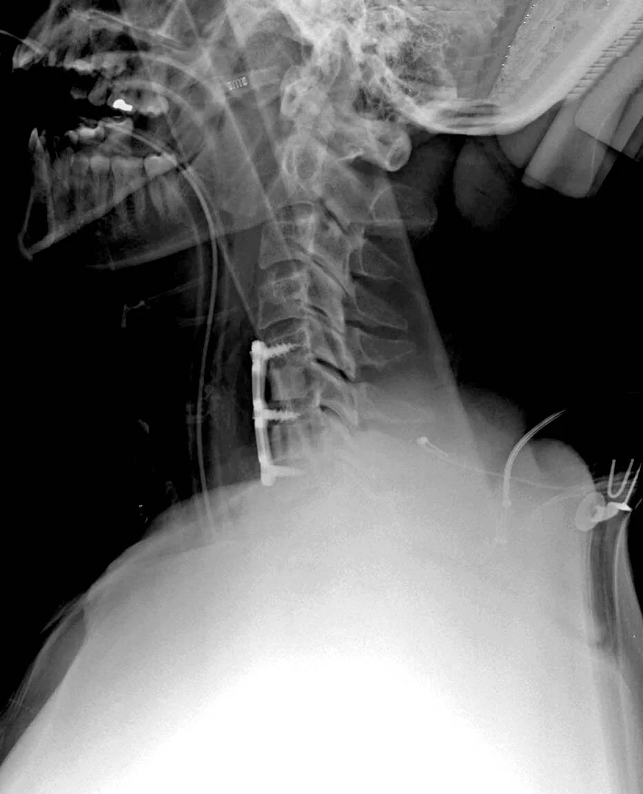 Dr. Jonathan Citow's Innovations – The American Center for Spine and ...