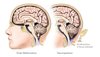 Chiari Malformation – Brain Conditions – The American Center for Spine ...
