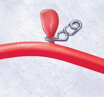 Aneurysm Clipping/Coiling – Brain Surgeries – The American Center for ...