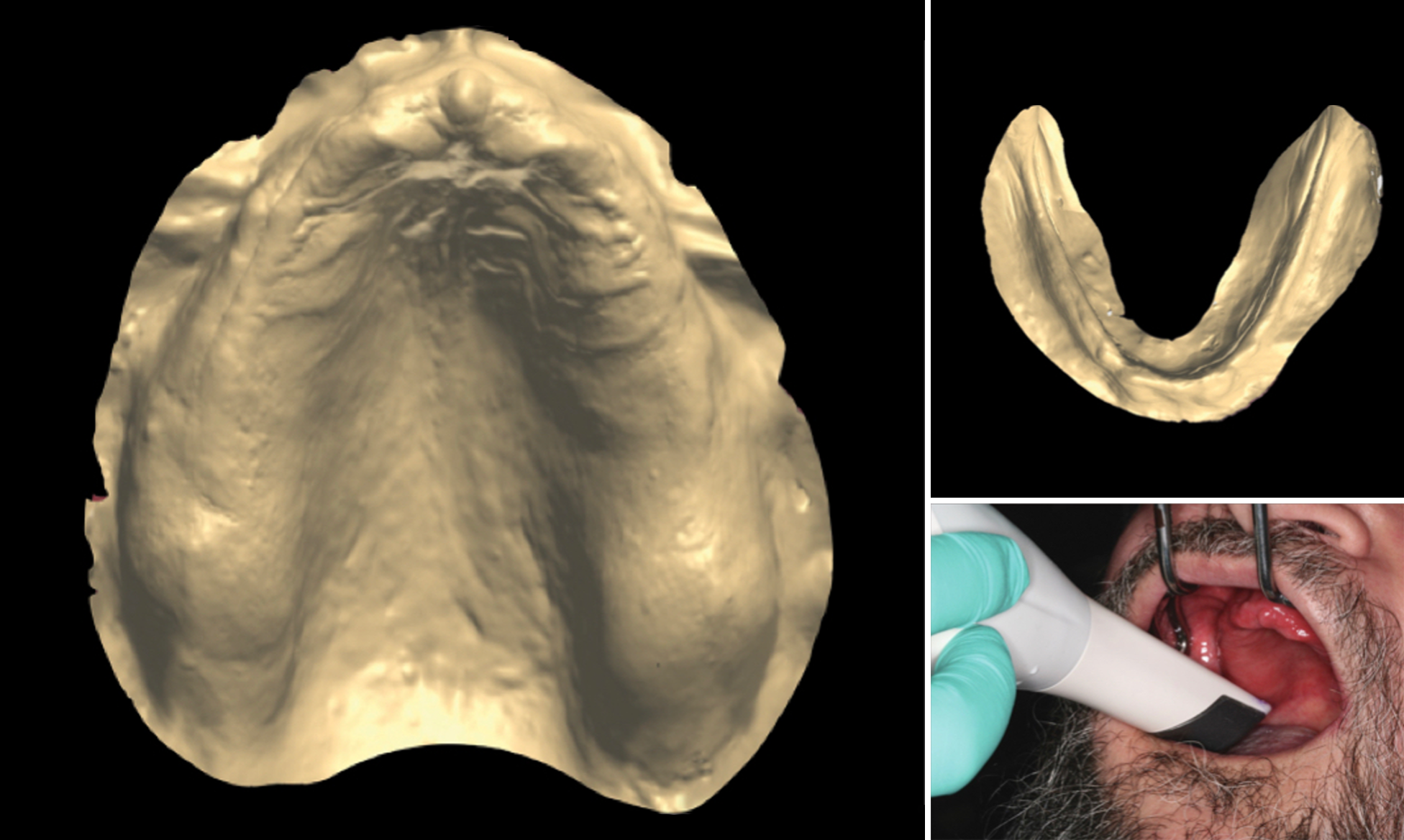 Advantages of Digital Removable Prosthodontics — MODERN DENTAL