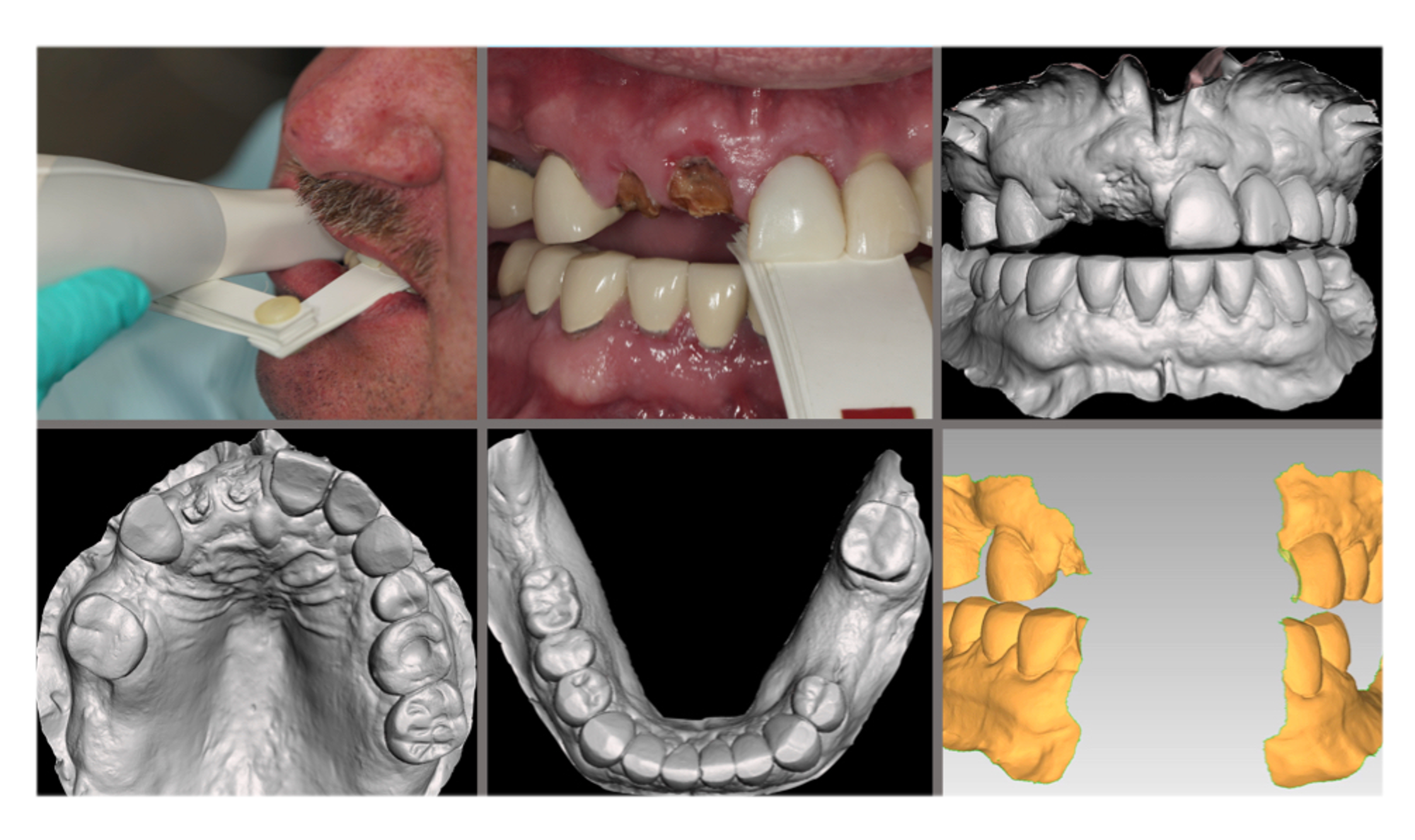 Advantages of Digital Removable Prosthodontics — MODERN DENTAL