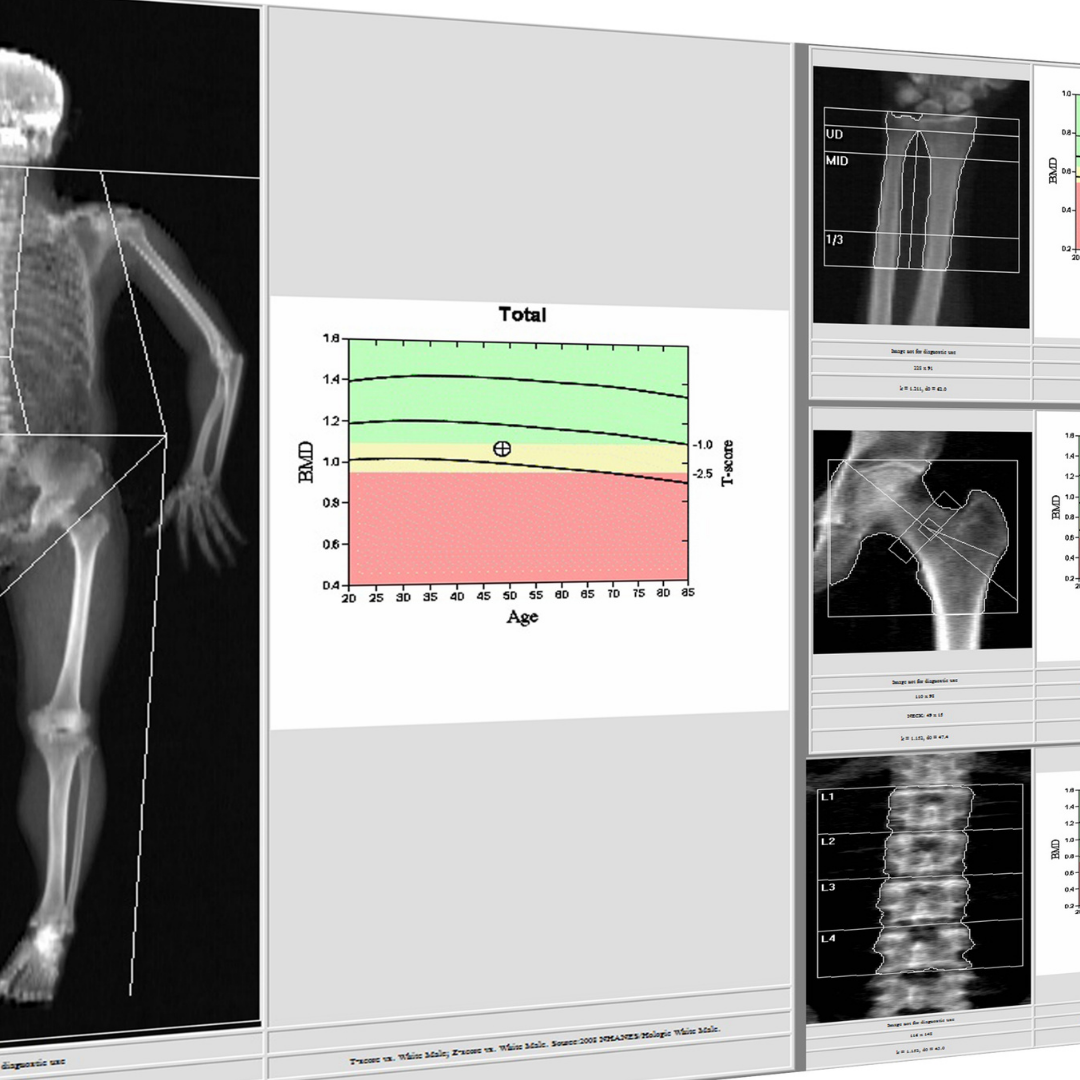 Osteoporosis- Symptoms, diagnoses and 9 ways you can prevent it ...