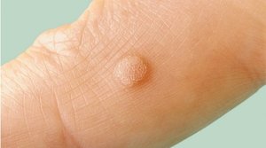 How to get rid of warts — Dermatology Arts