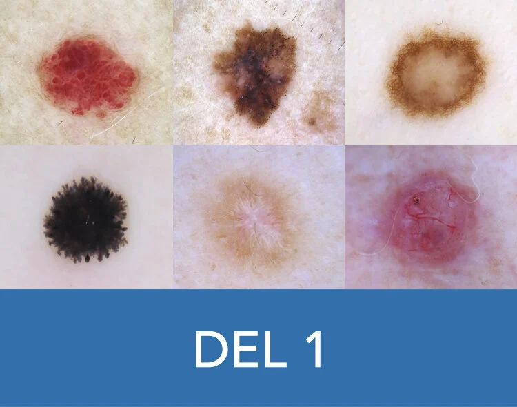 Dermatoskopi i primärvård - Lär dig att diagnostisera hudcancer