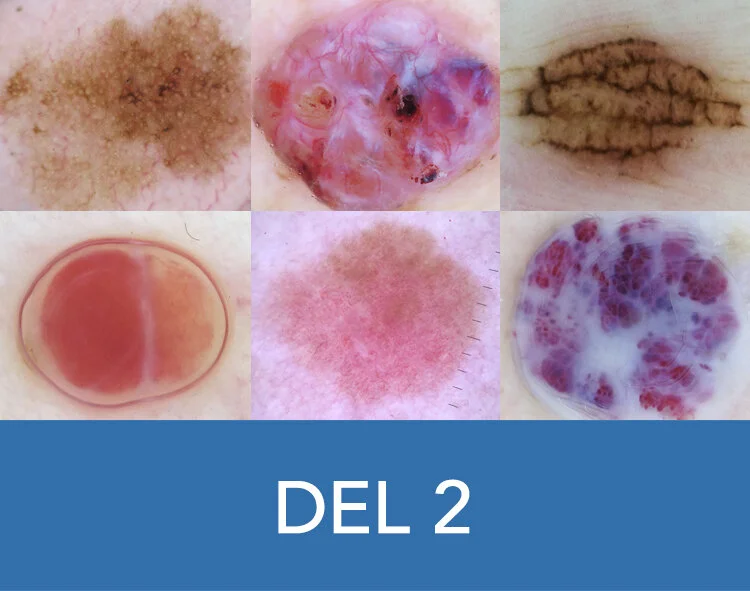 Dermatoskopi i primärvård - Lär dig att diagnostisera hudcancer