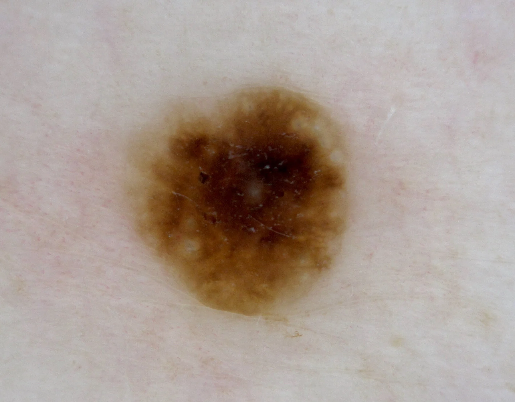 Kontakta Dermatoskopi i primärvård — Dermatoskopi i primärvård - Lär ...