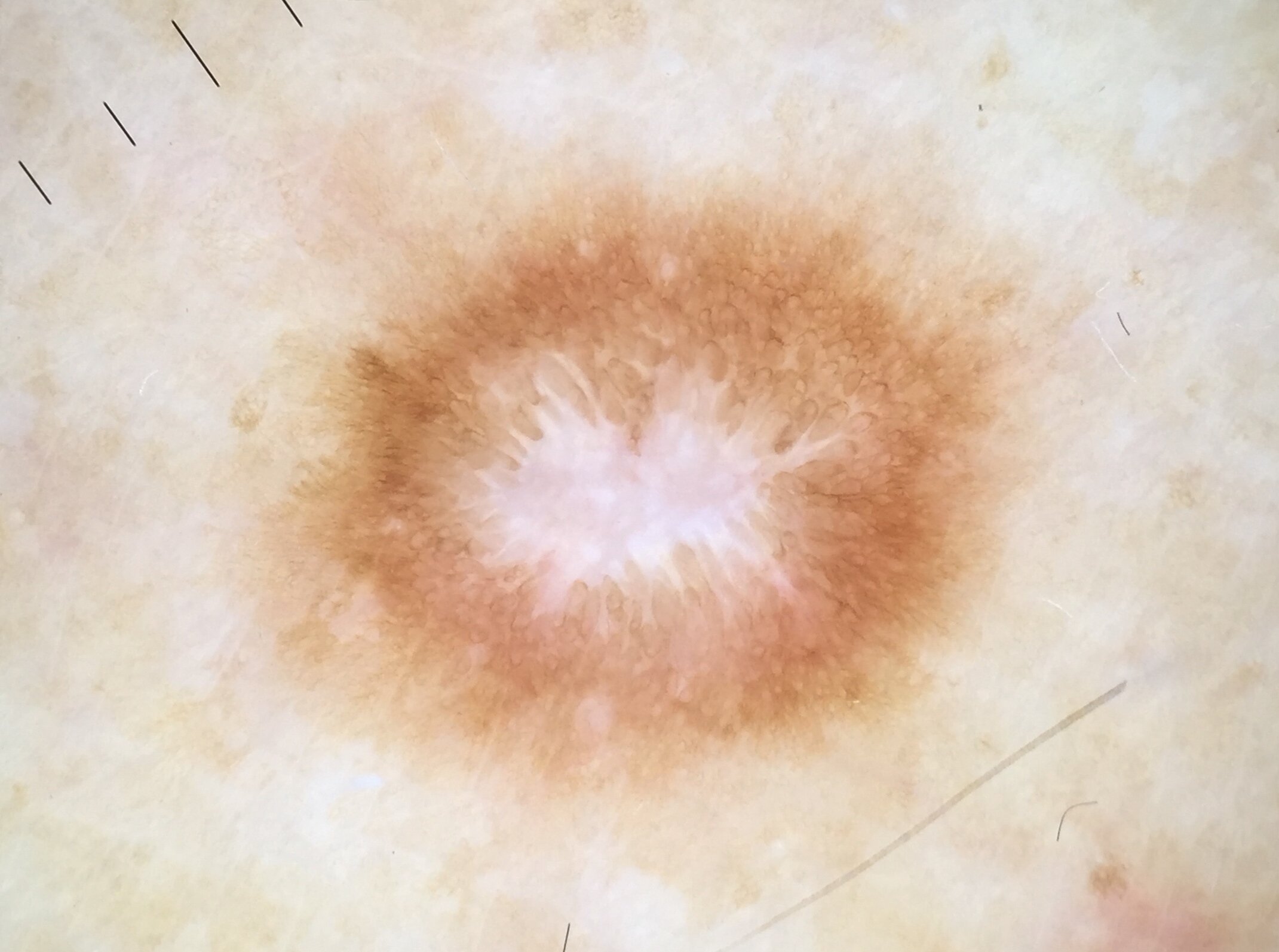 Kontakta Dermatoskopi i primärvård — Dermatoskopi i primärvård - Lär ...