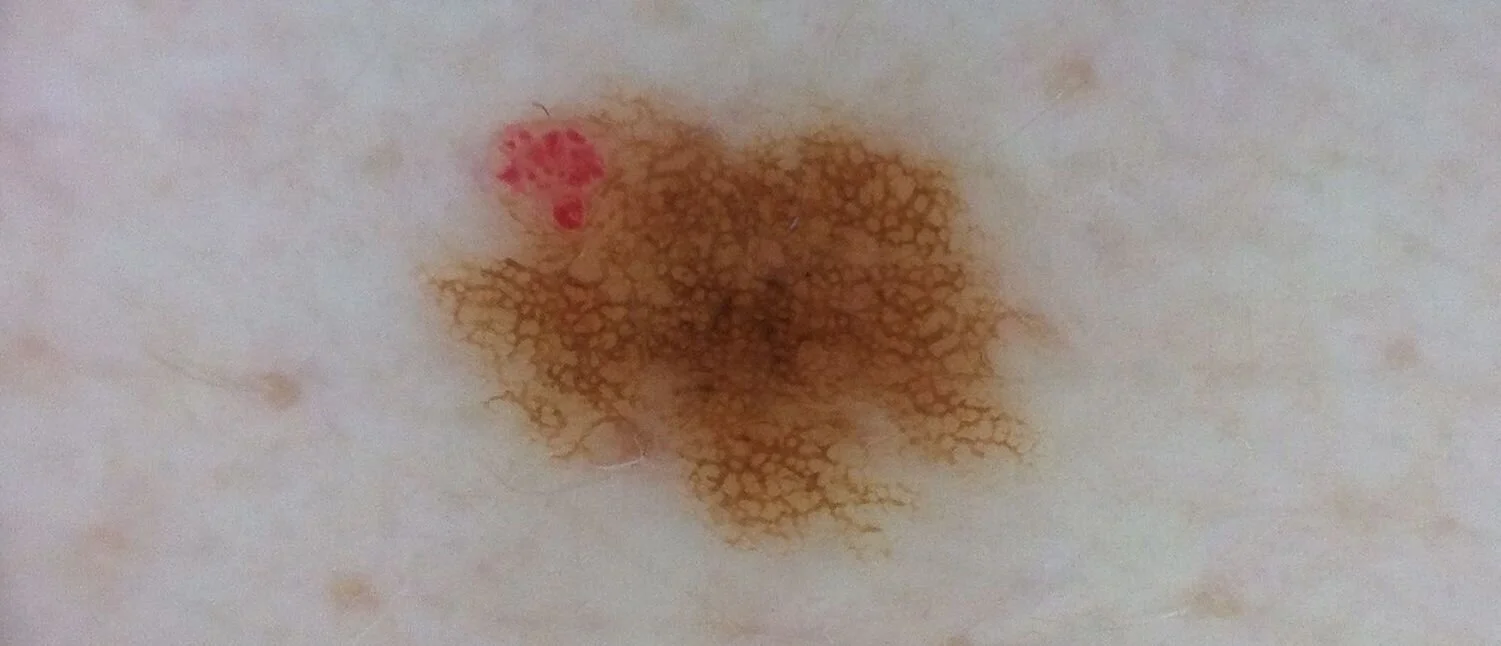 Info Dermatoskopi i Primärvård — Dermatoskopi i primärvård - Lär dig ...