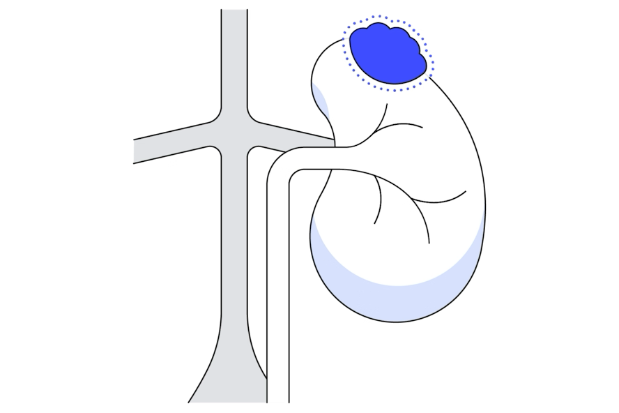 Kidney cancer surgery – minimally invasive nephrectomy | Central East ...