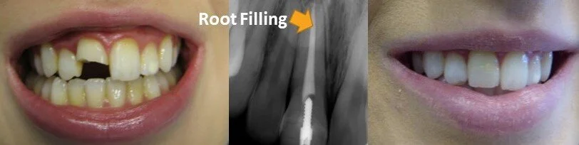 Root Canal Front Tooth Before And After