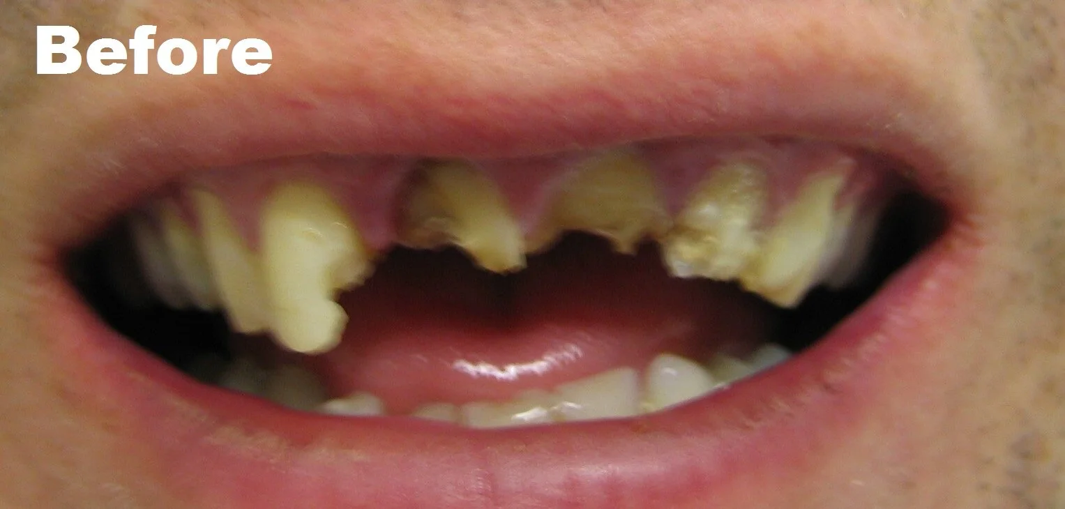 BROKEN FRONT TOOTH — Deva Dental Clinic