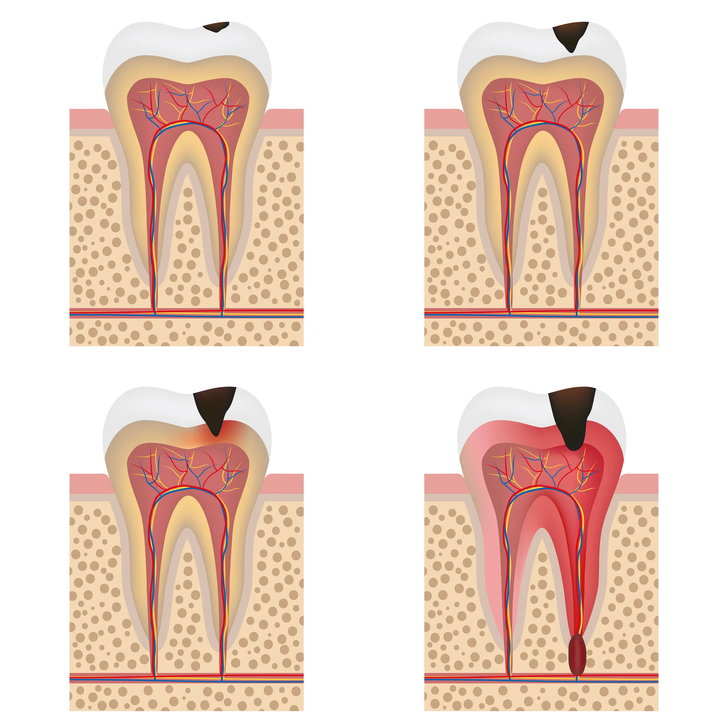 Root Canal Treatment | Costs | Pain Management | Root | Filling ...